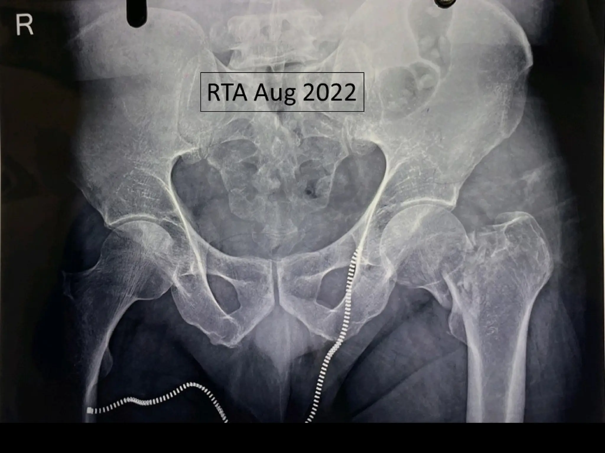 Non-Union of Fracture Neck of Femur.pptx