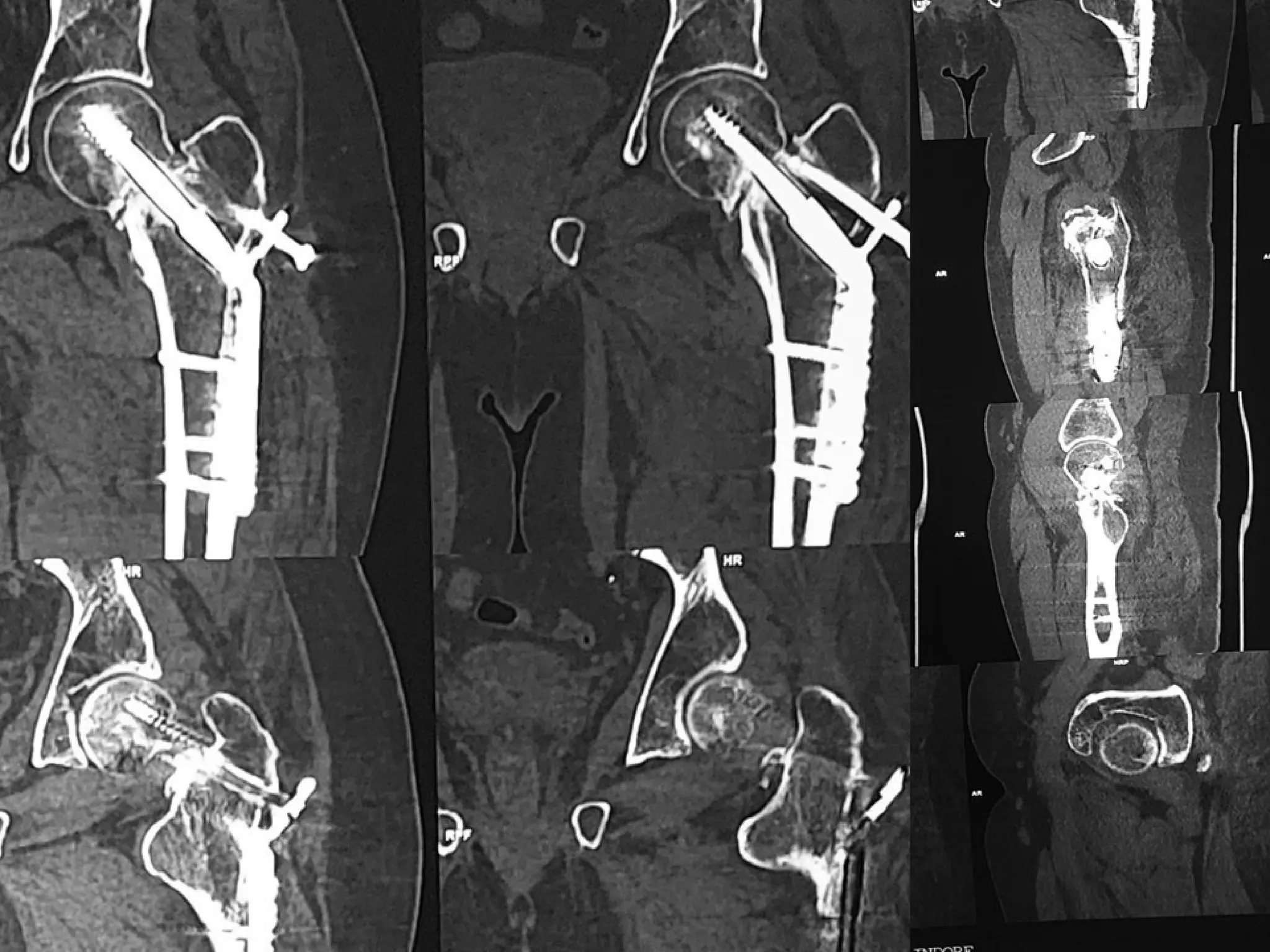Non-Union of Fracture Neck of Femur.pptx
