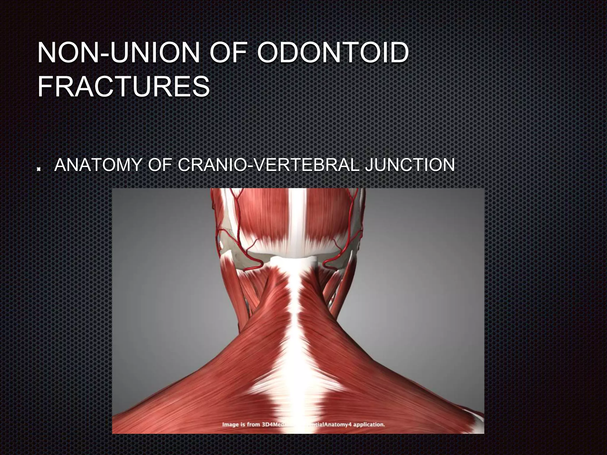 Non union of odontoid fractures | PPTX