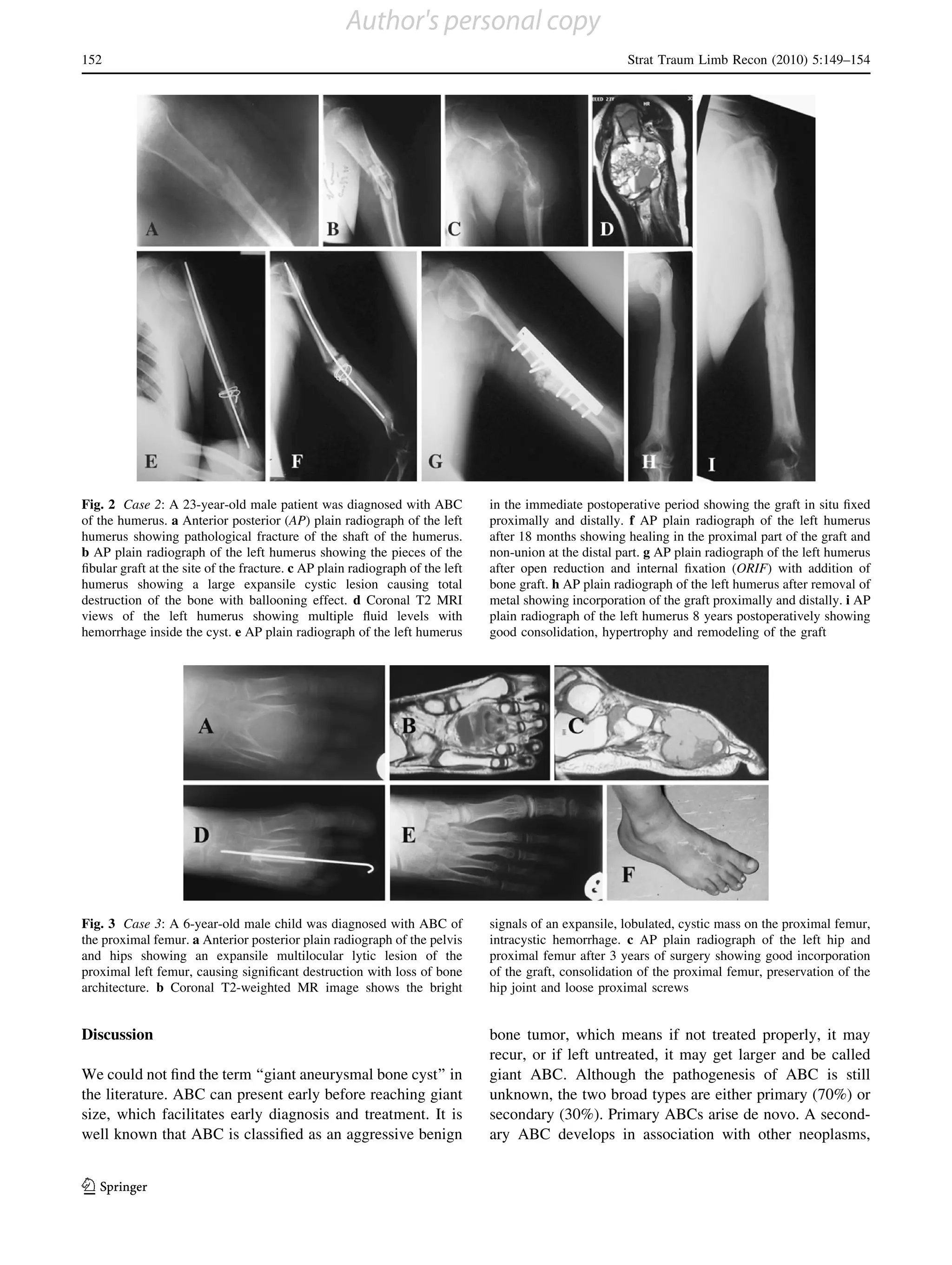 Non-vascularized fibular graft reconstruction after resection.pdf