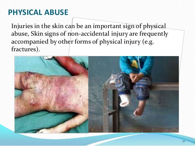 Non accidental child injury 01