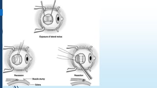 Non- Accommodative Convergent Squint | PPTX