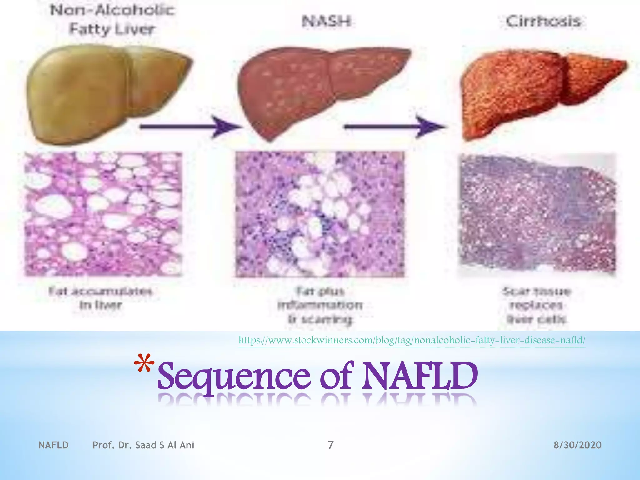 Nafld In Children | Fatty liver in children: Signs, causes, and ...