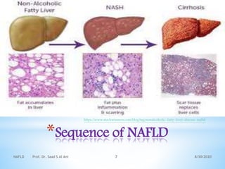 Nonalcoholic fatty liver disease NAFLD in children | PPTX