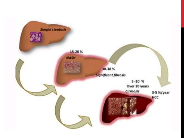 Non-Alcoholic Fatty Liver Disease (NAFLD) | PPTX