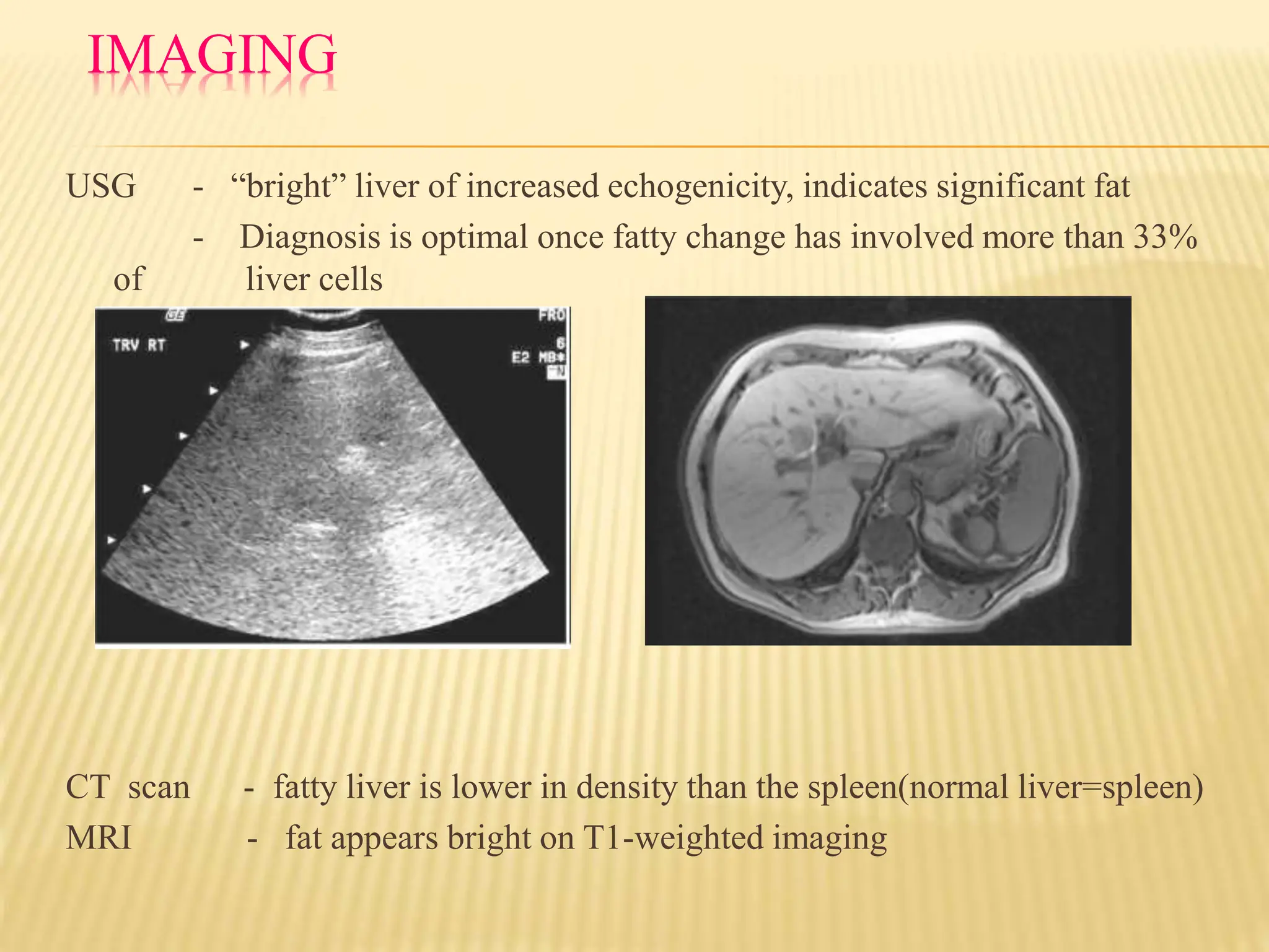 NON ALCOHOLIC FATTY LIVER DISEASES modify (edited by Kyin).pptx