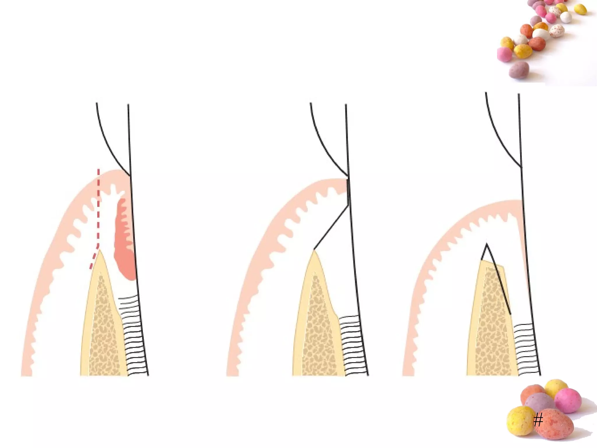 Non bone graft associated new attachment procedures | PPT