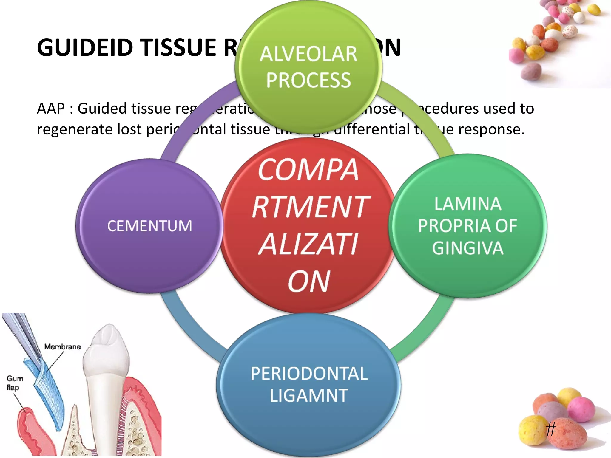 Non bone graft associated new attachment procedures | PPT