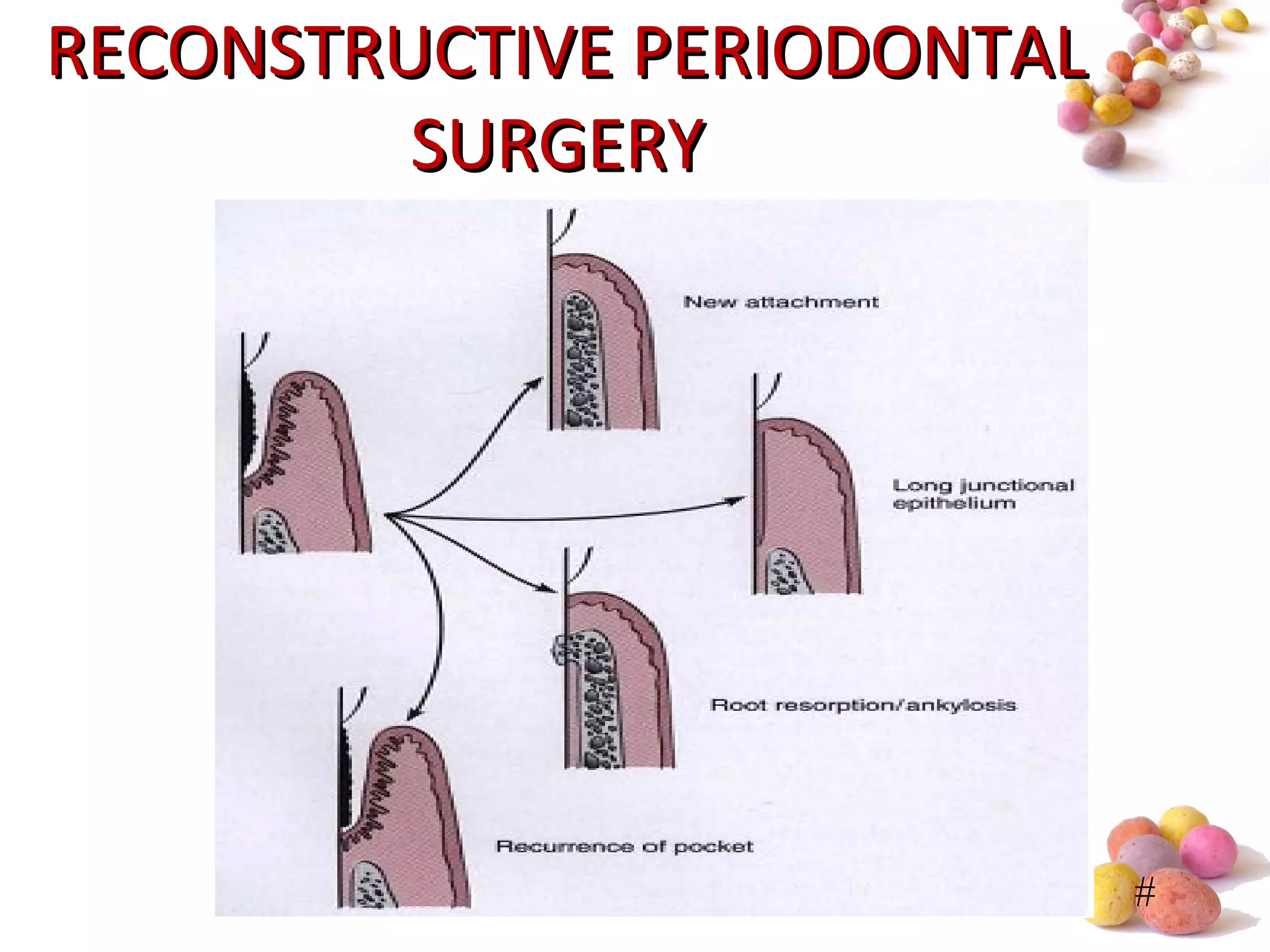 Non bone graft associated new attachment procedures | PPT