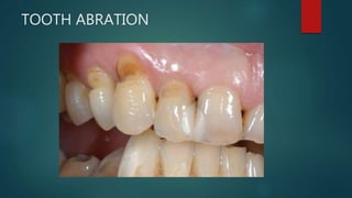 Non –carious lesion | PPTX