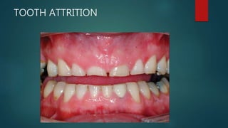 Non –carious lesion | PPTX