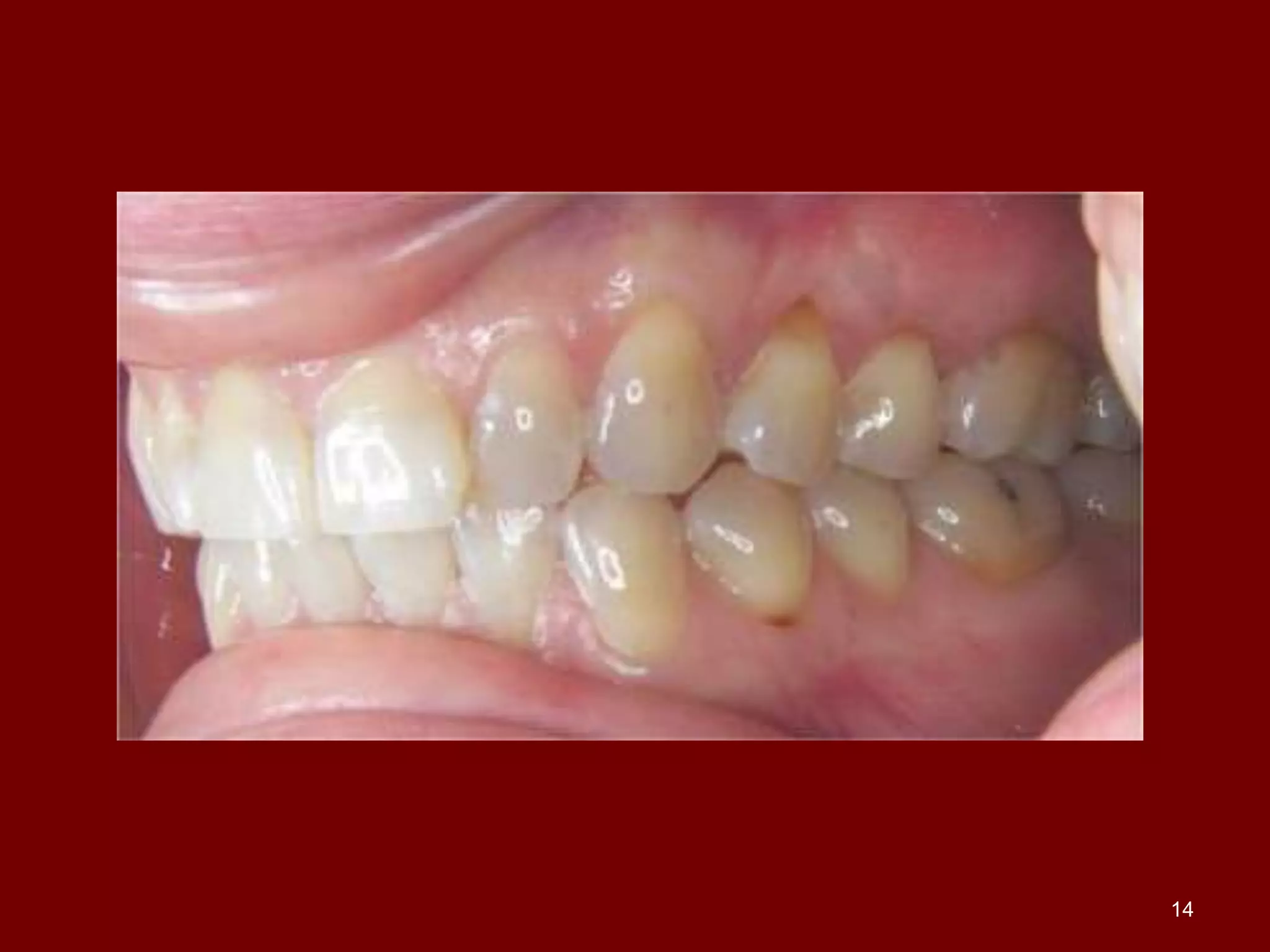 NON CARIOUS LESIONS AND MANAGEMENT.pptx