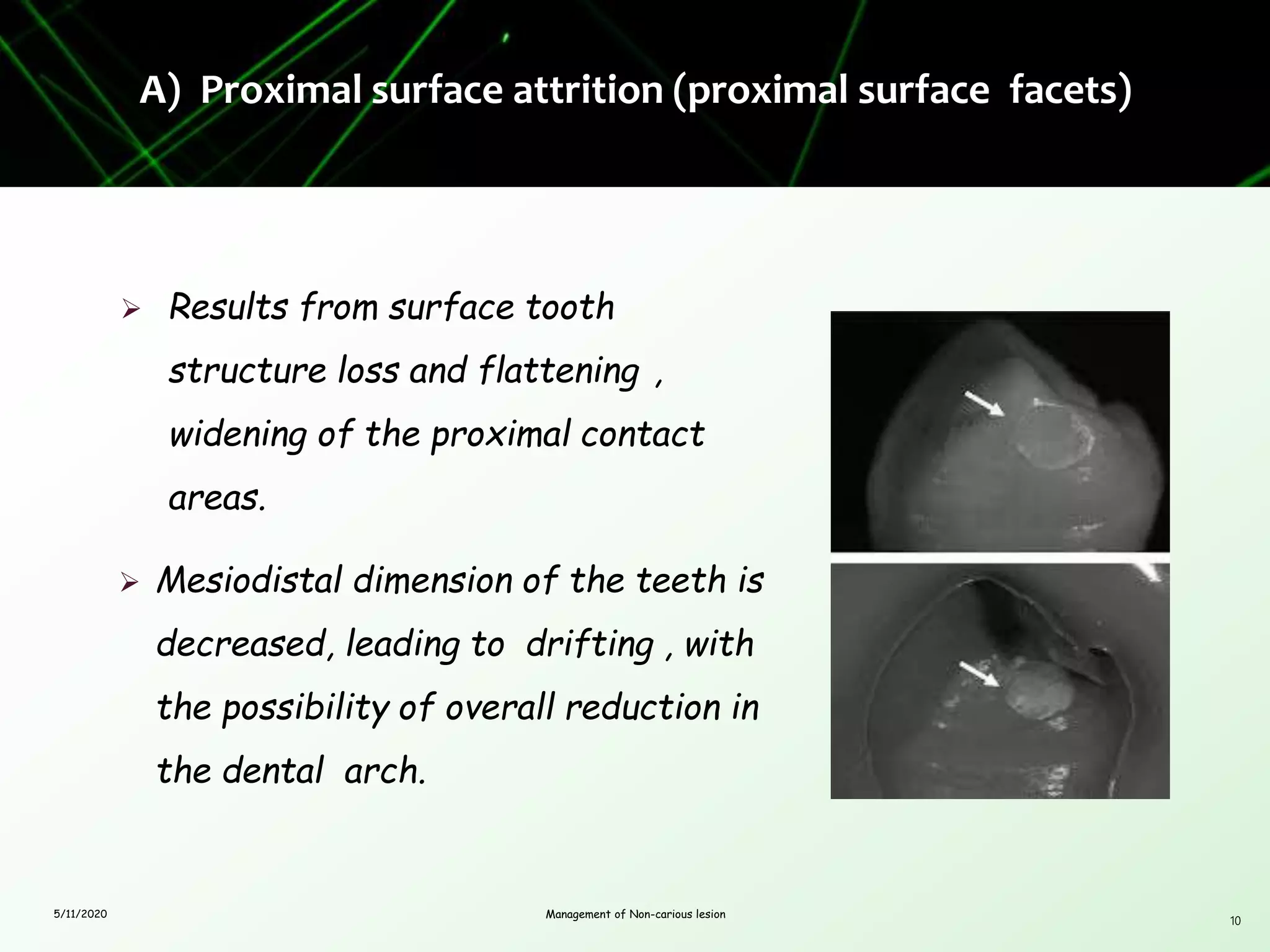 Non carious tooth lesions | PPTX
