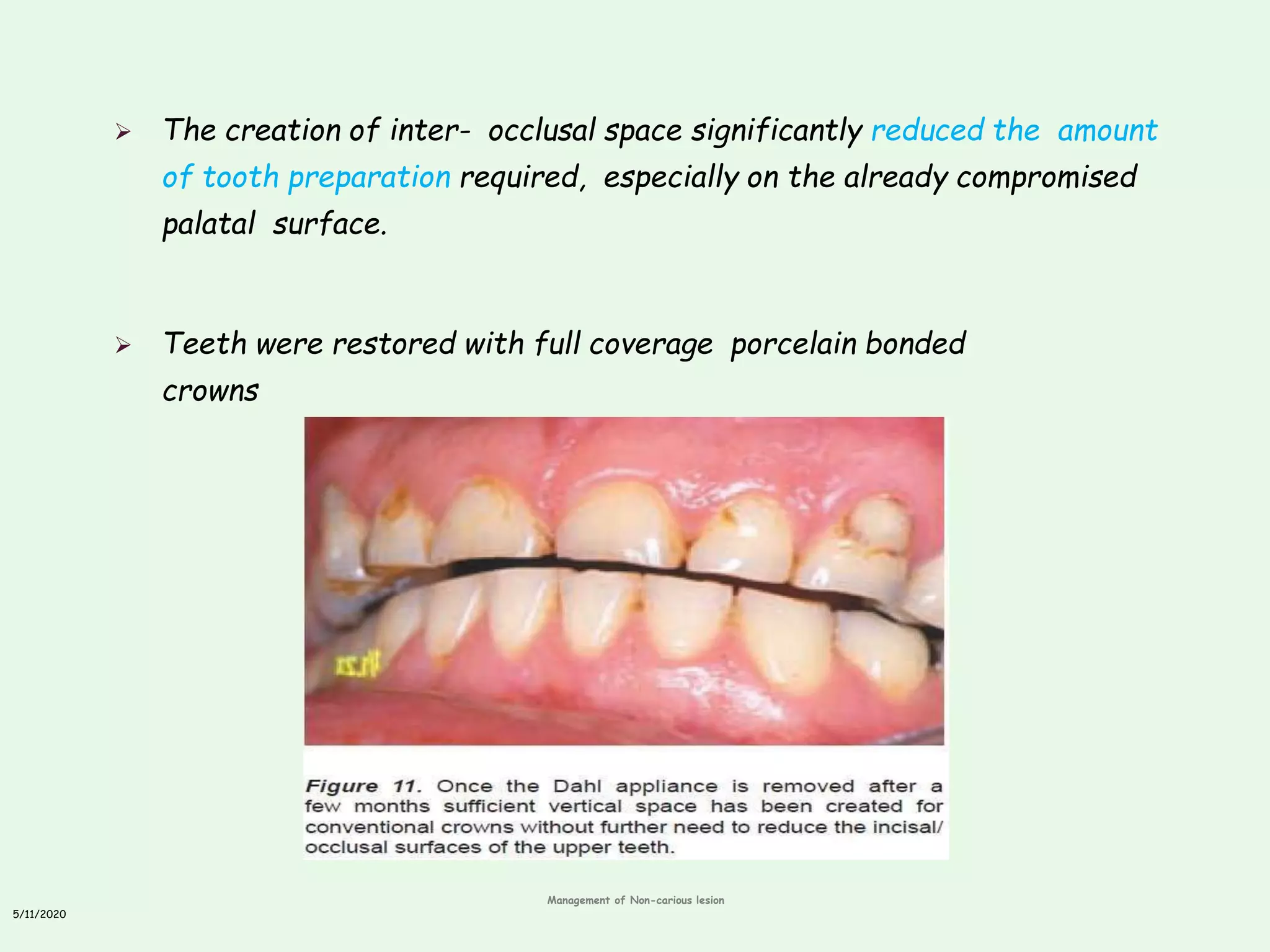 Non carious tooth lesions | PPTX