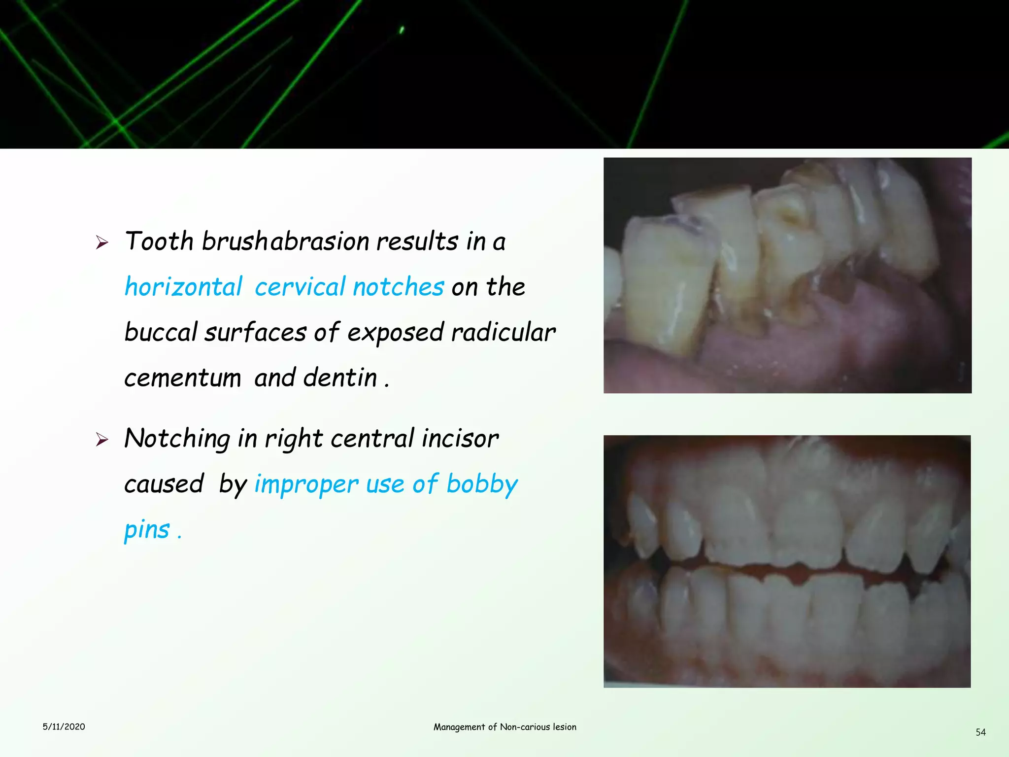 Non carious tooth lesions | PPTX
