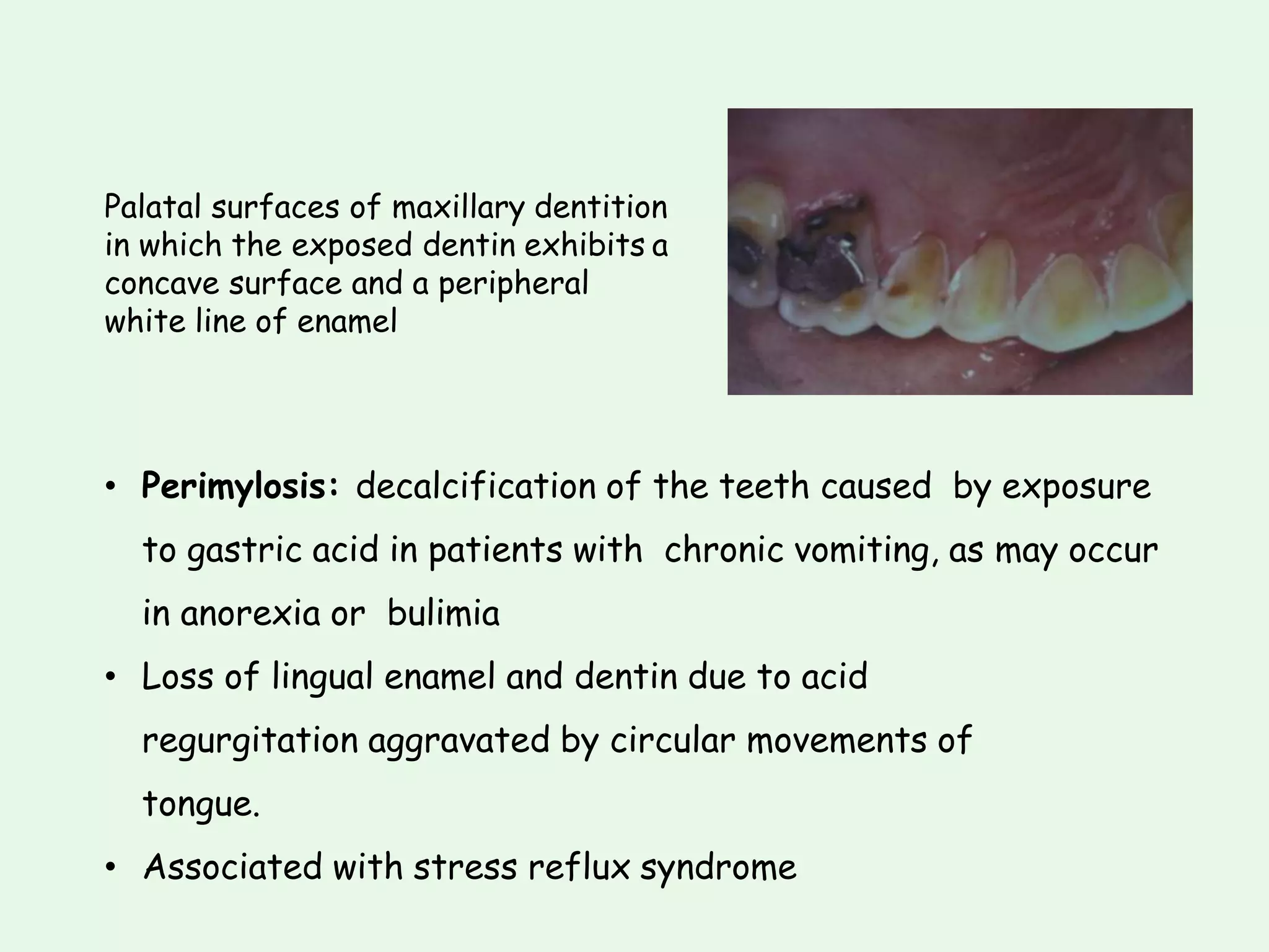 Non carious tooth lesions | PPTX