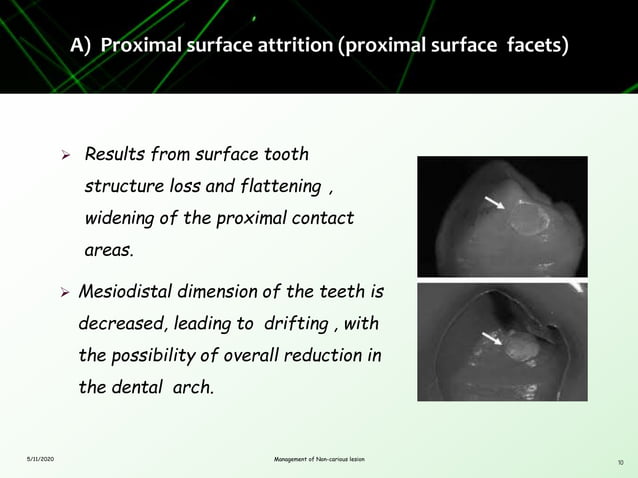 Non carious tooth lesions | PPTX