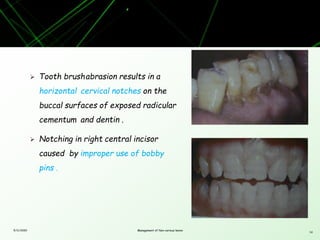 Non carious tooth lesions | PPTX