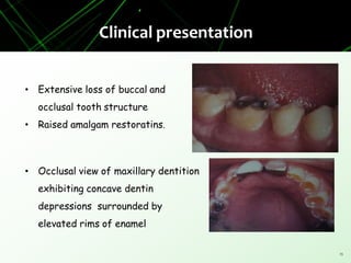 Non carious tooth lesions | PPTX