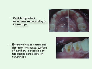Non carious tooth lesions | PPTX