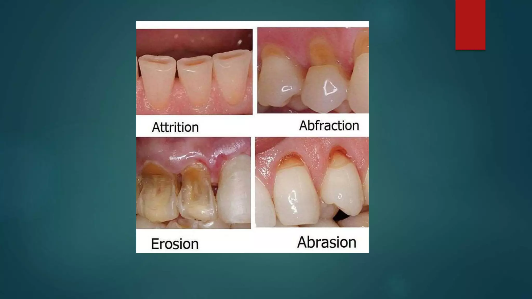 NON CARIOUS TOOTH SURFACE LOSS | PPTX