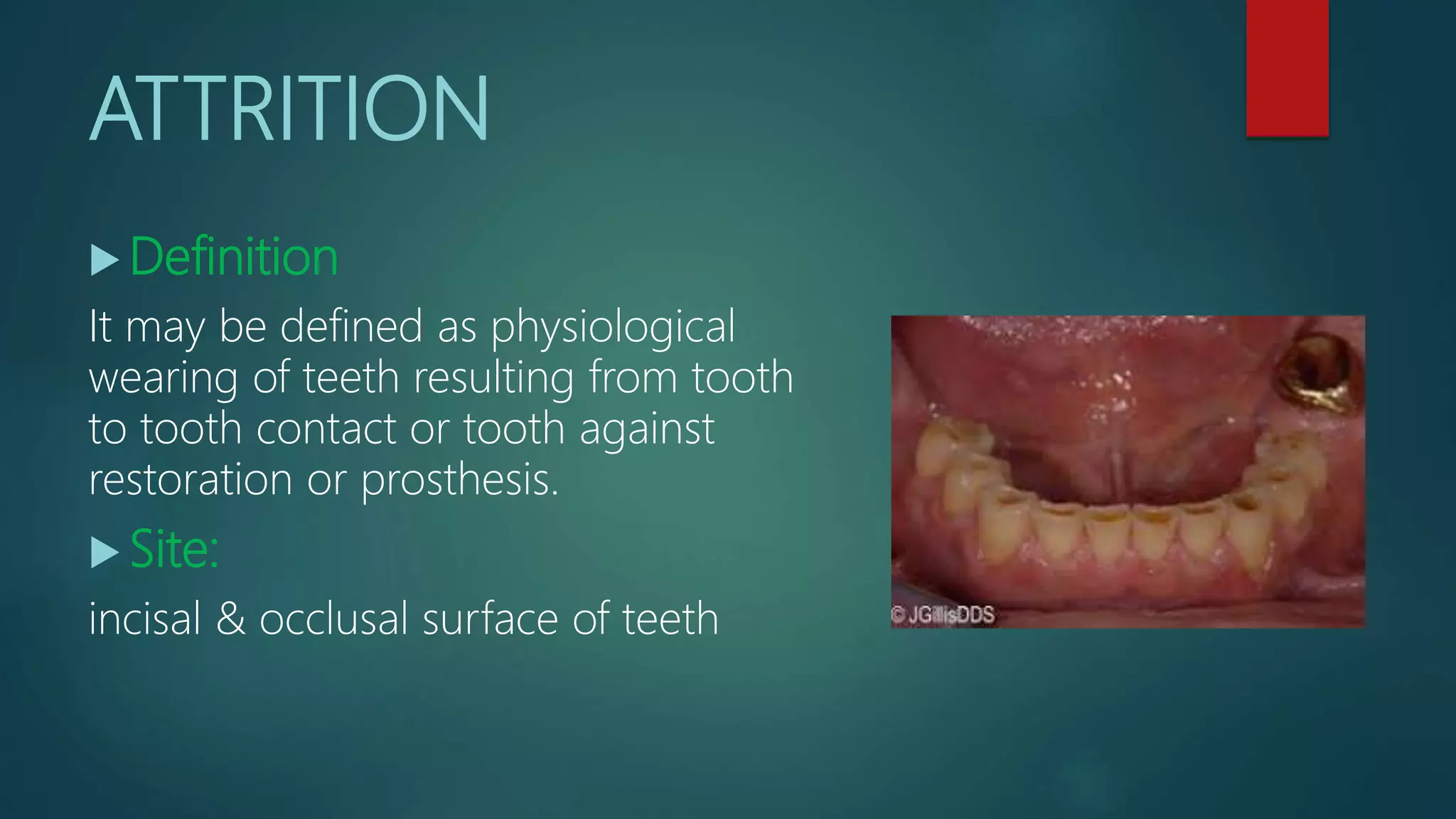 NON CARIOUS TOOTH SURFACE LOSS | PPTX