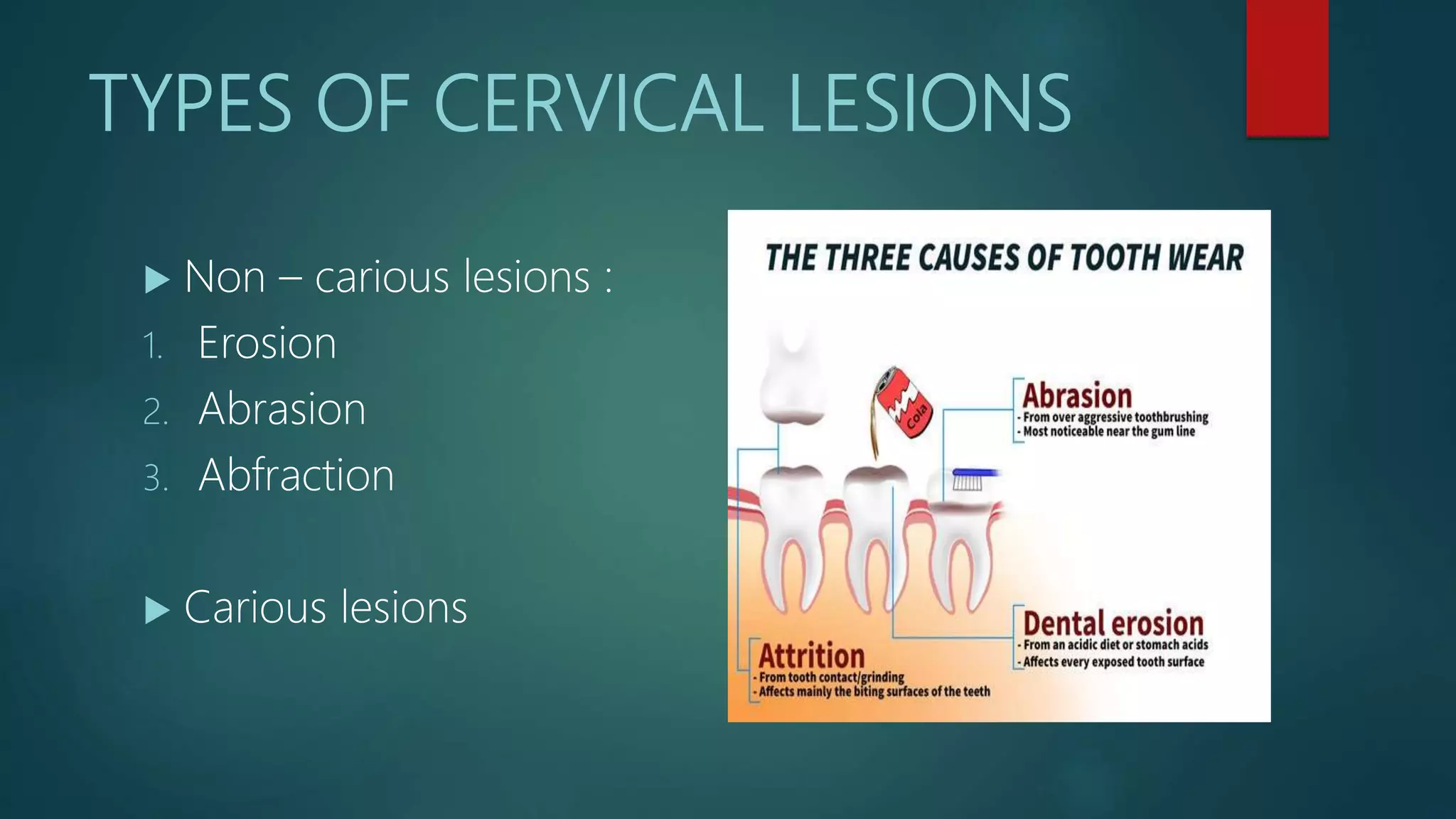 NON CARIOUS TOOTH SURFACE LOSS | PPTX