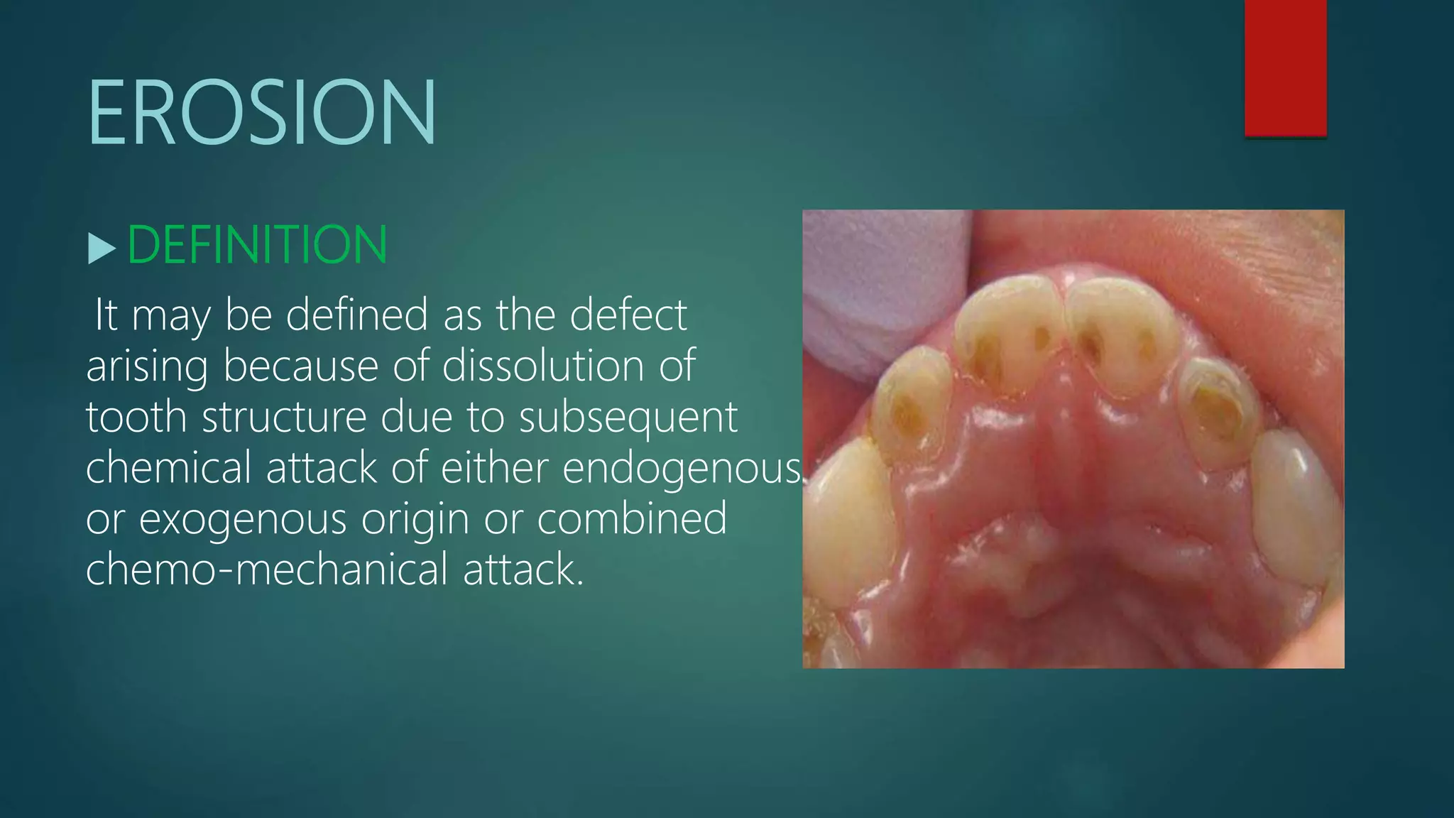 NON CARIOUS TOOTH SURFACE LOSS | PPTX
