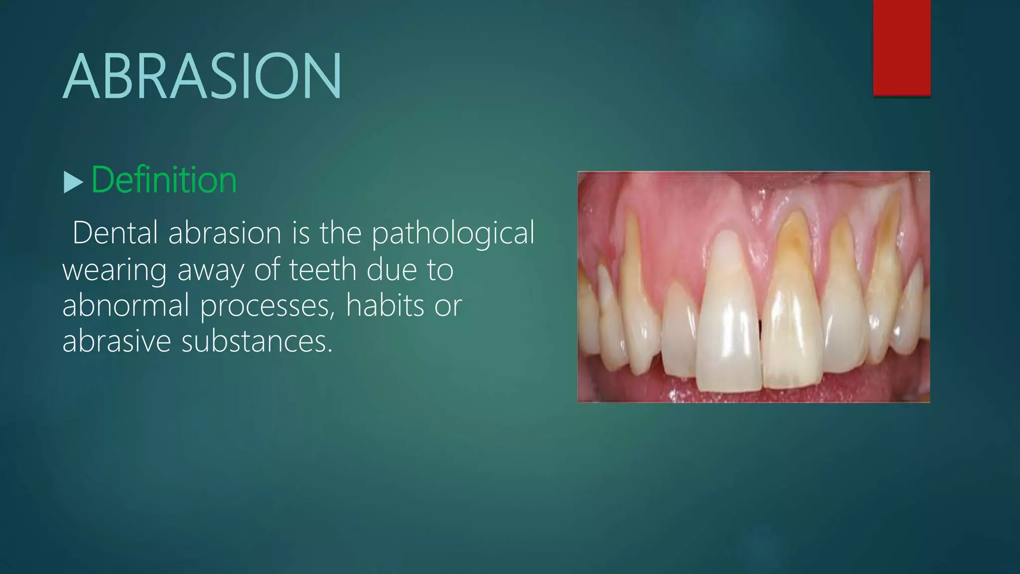 NON CARIOUS TOOTH SURFACE LOSS | PPTX