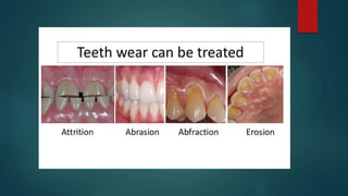 NON CARIOUS TOOTH SURFACE LOSS | PPTX