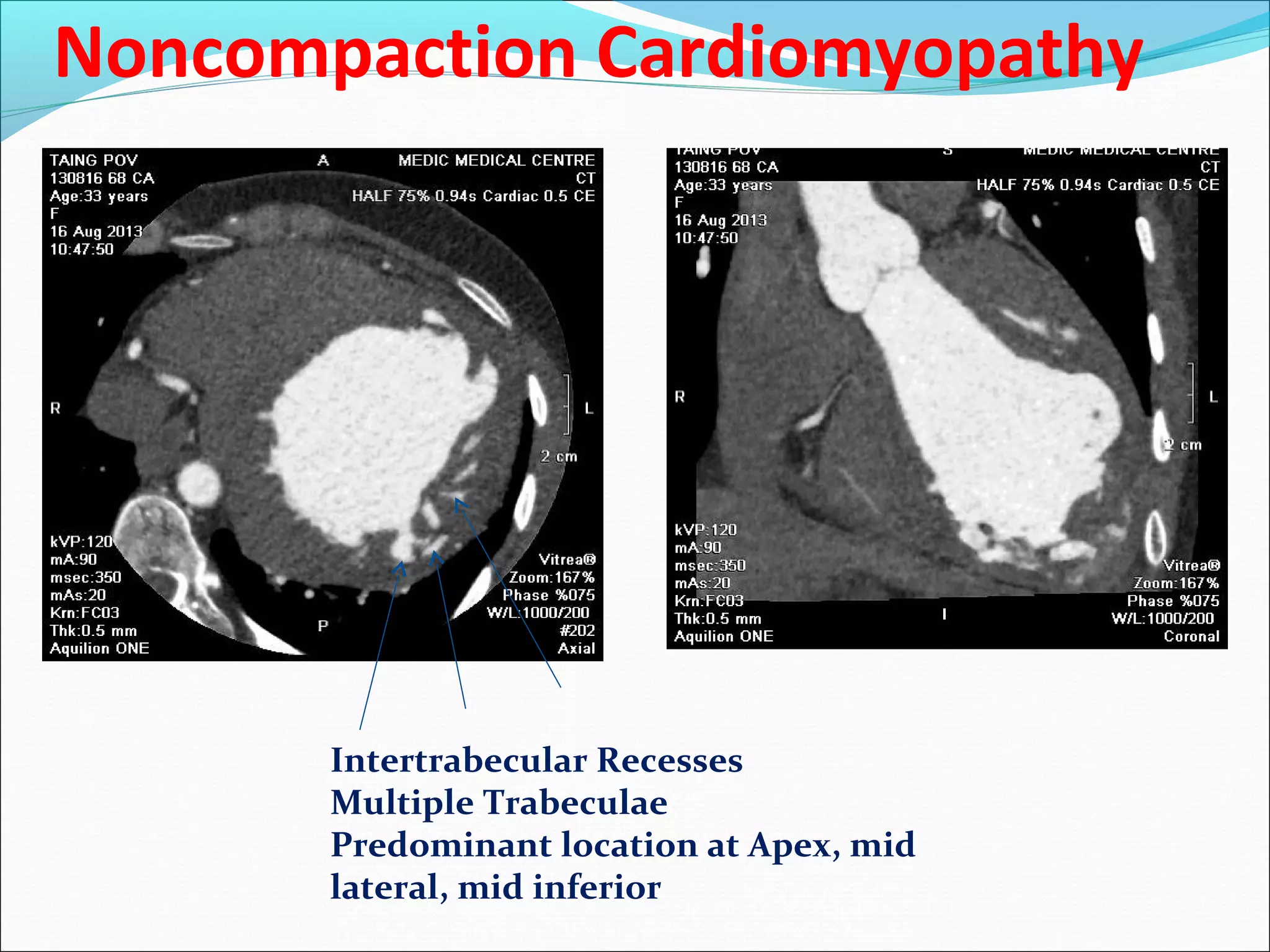Noncompaction Cardiomyopathy, NGUYEN TUAN VU, NGUYEN THI KIM SANG ...