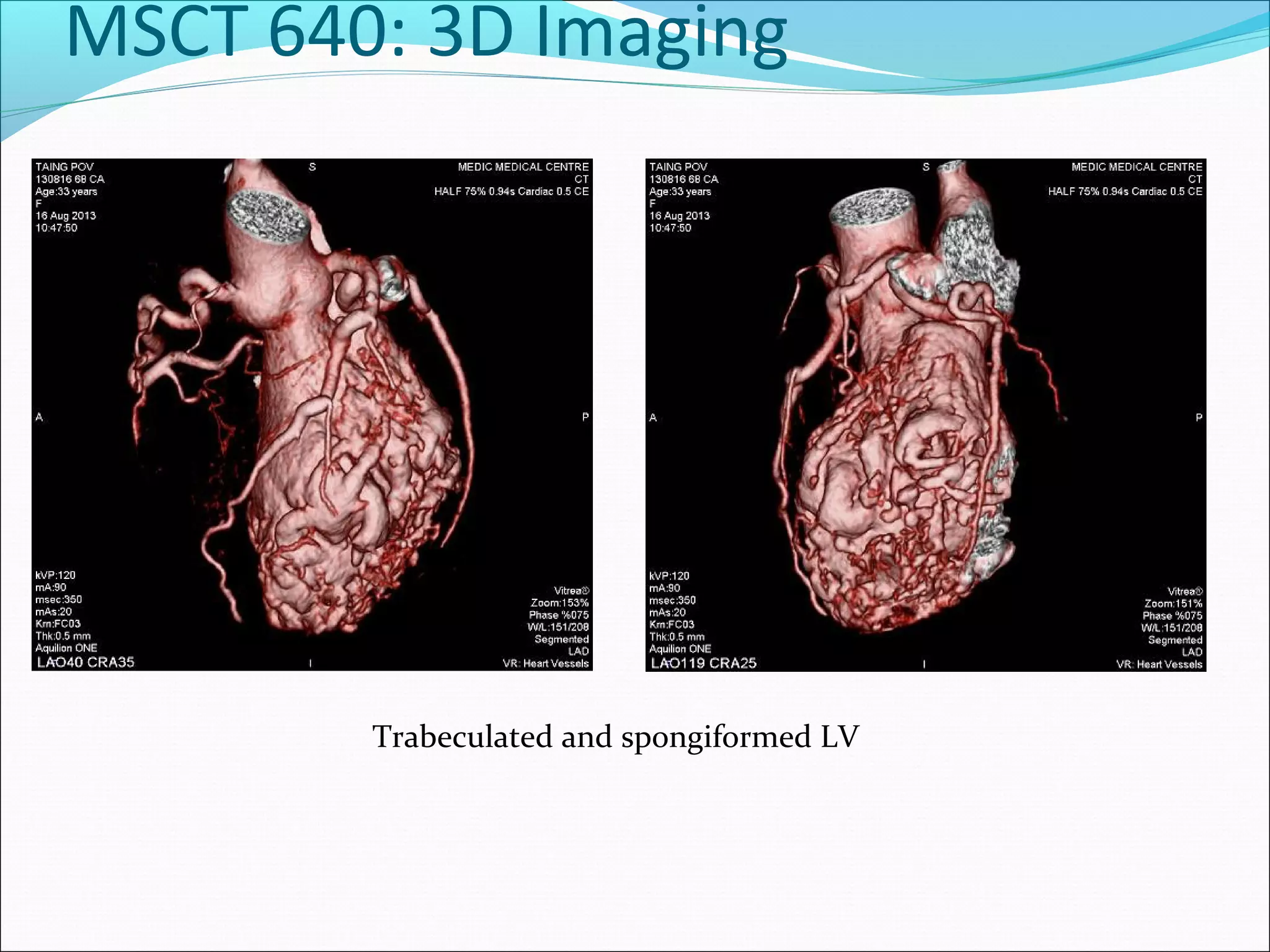 Noncompaction Cardiomyopathy, NGUYEN TUAN VU, NGUYEN THI KIM SANG ...