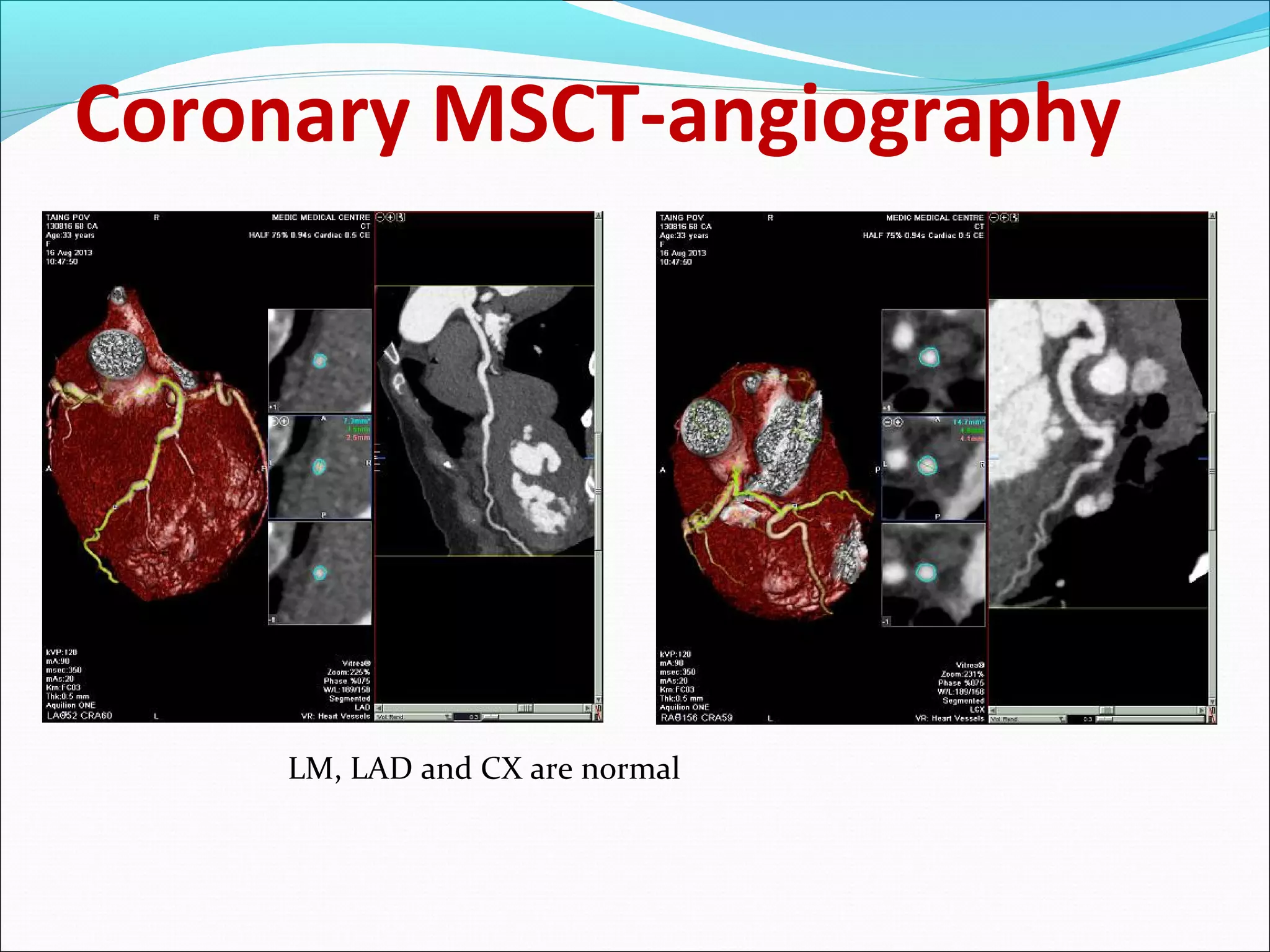 Noncompaction Cardiomyopathy, NGUYEN TUAN VU, NGUYEN THI KIM SANG ...