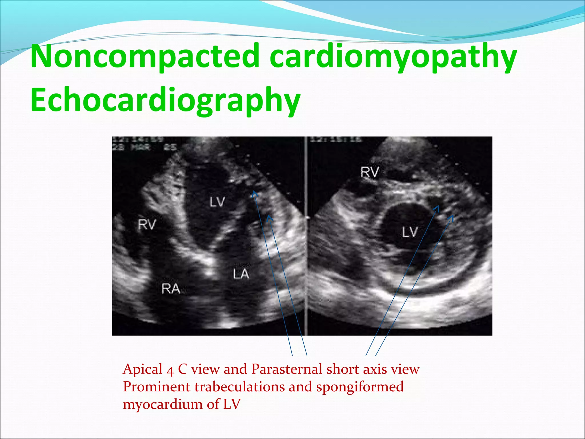 Noncompaction Cardiomyopathy, NGUYEN TUAN VU, NGUYEN THI KIM SANG ...