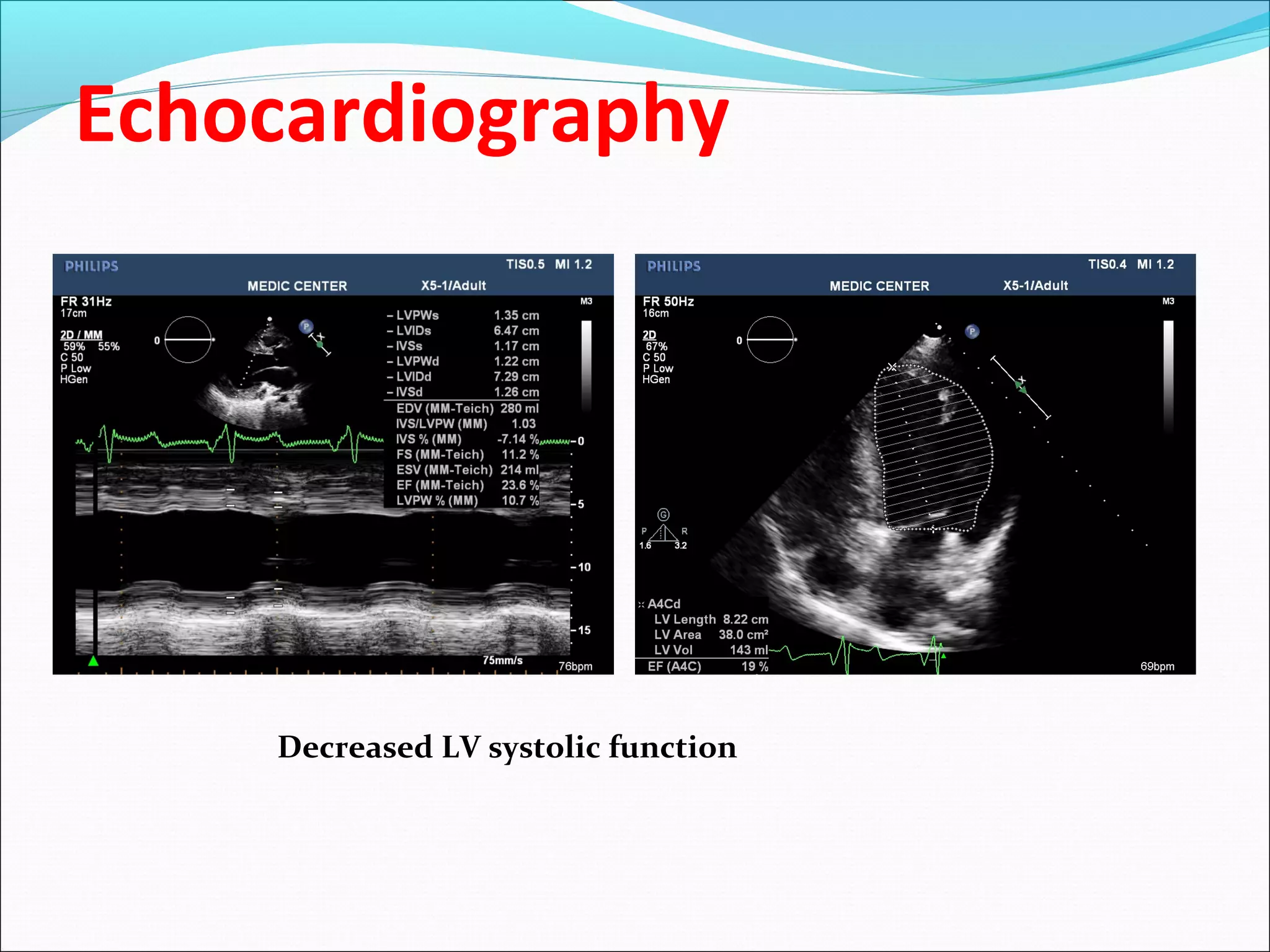 Noncompaction Cardiomyopathy, NGUYEN TUAN VU, NGUYEN THI KIM SANG ...