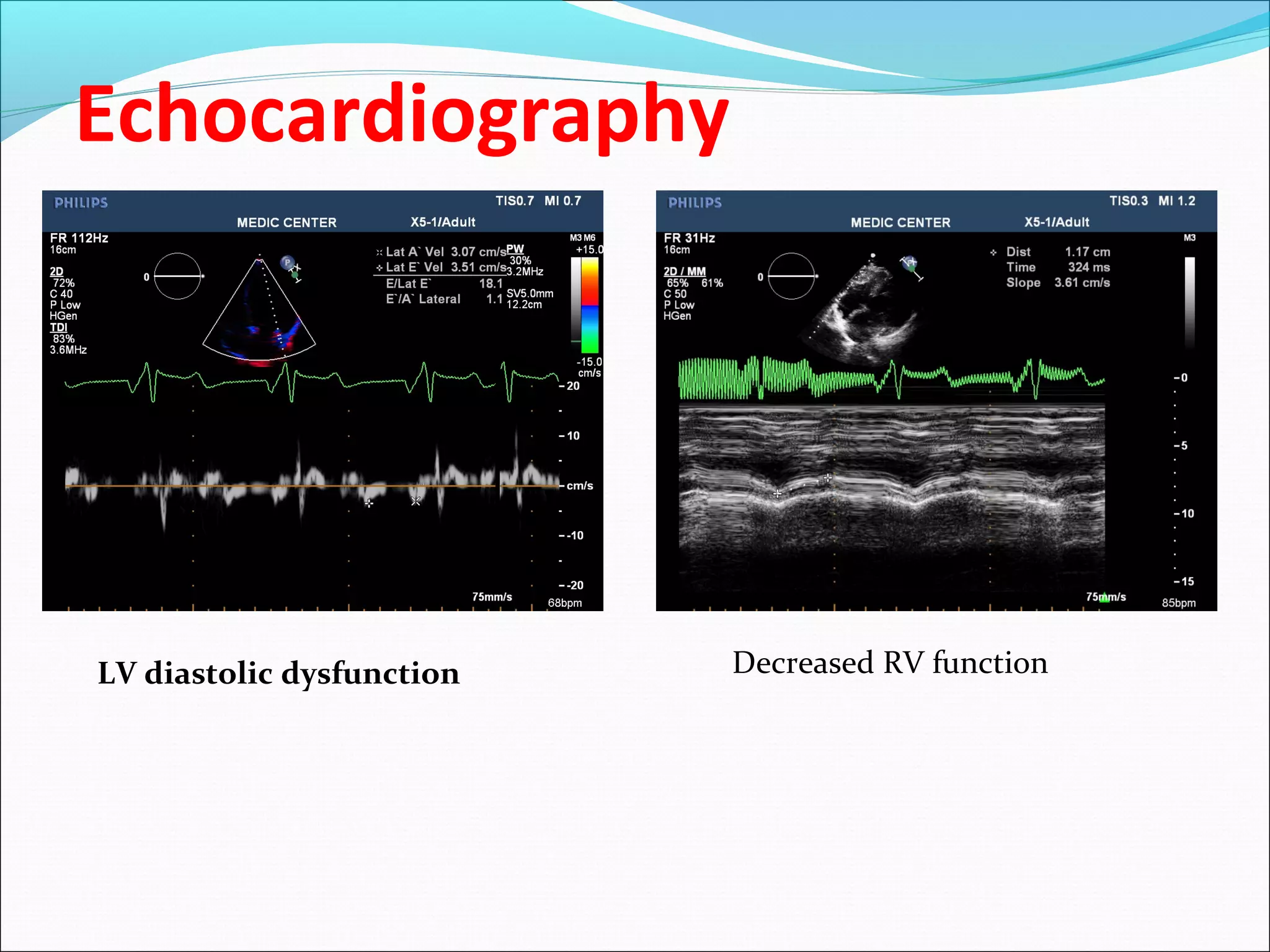 Noncompaction Cardiomyopathy, NGUYEN TUAN VU, NGUYEN THI KIM SANG ...