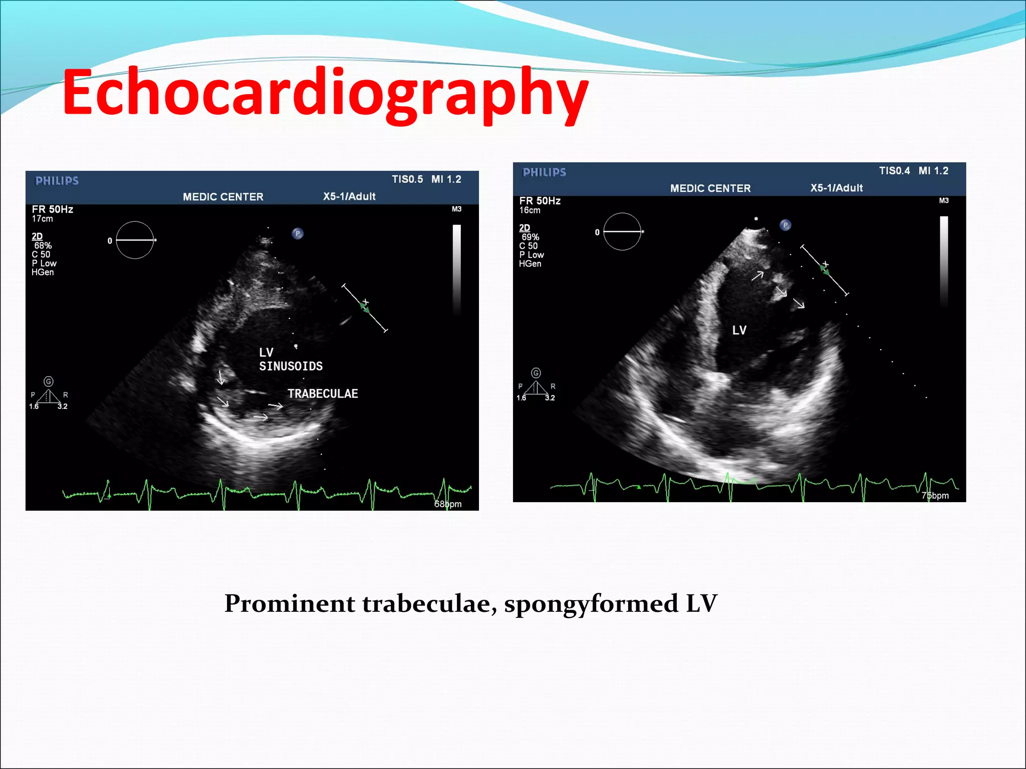 Noncompaction Cardiomyopathy, NGUYEN TUAN VU, NGUYEN THI KIM SANG ...