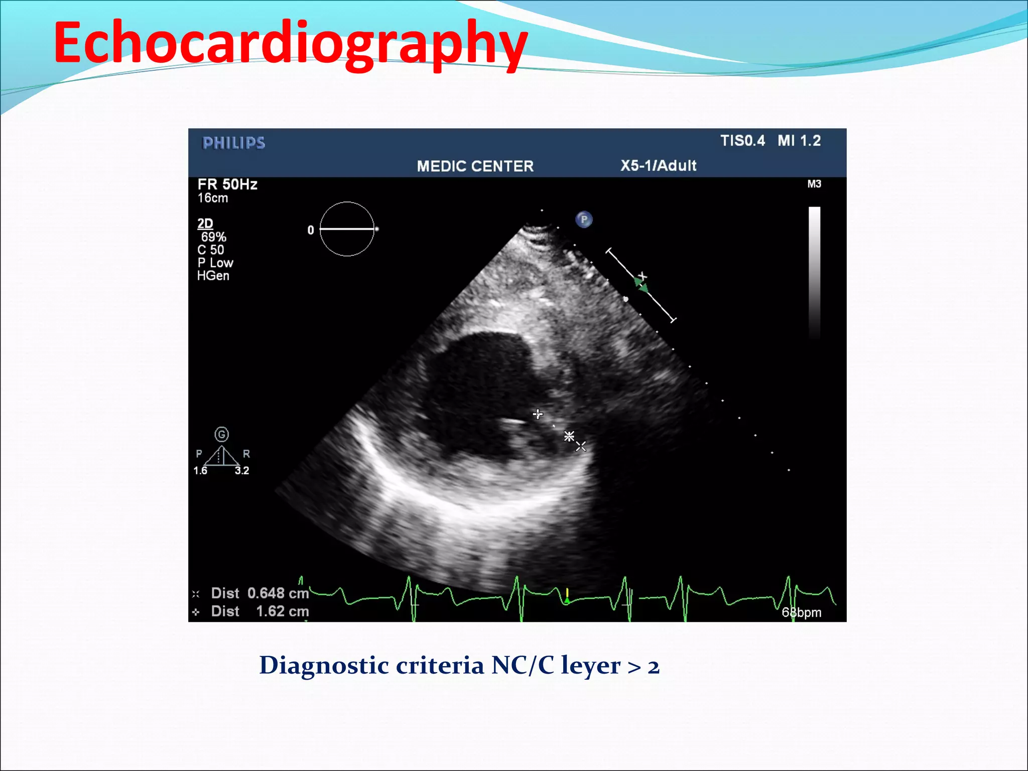 Noncompaction Cardiomyopathy, NGUYEN TUAN VU, NGUYEN THI KIM SANG ...