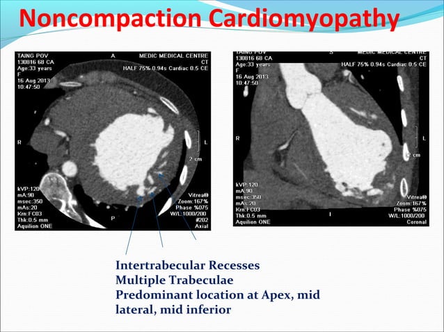 Noncompaction Cardiomyopathy, NGUYEN TUAN VU, NGUYEN THI KIM SANG ...