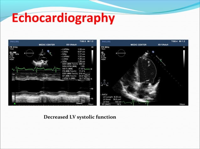 Noncompaction Cardiomyopathy, NGUYEN TUAN VU, NGUYEN THI KIM SANG ...