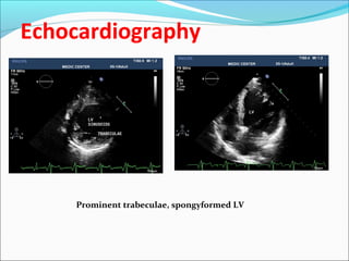 Noncompaction Cardiomyopathy, NGUYEN TUAN VU, NGUYEN THI KIM SANG ...