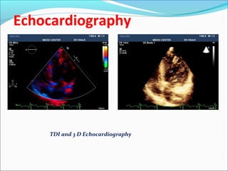 Noncompaction Cardiomyopathy, NGUYEN TUAN VU, NGUYEN THI KIM SANG ...