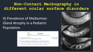 Noncontact Meibography.pptx