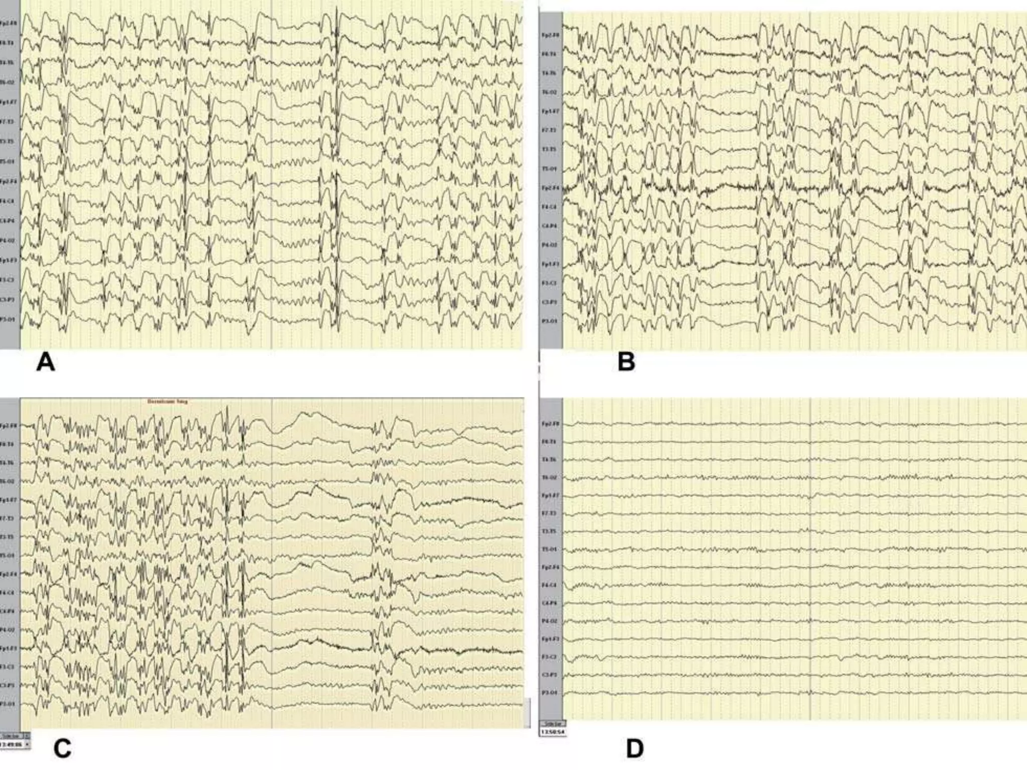 Non convulsive status epilepticus clinical features, diagnosis | PPTX