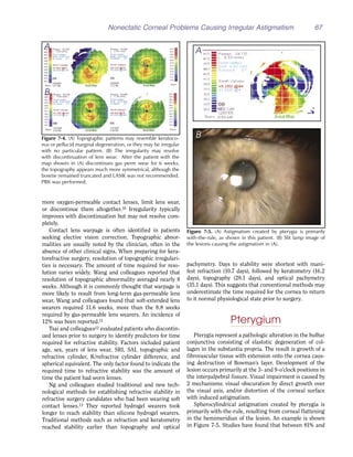 Non ectatic problems causing corneal astigmatism | PDF