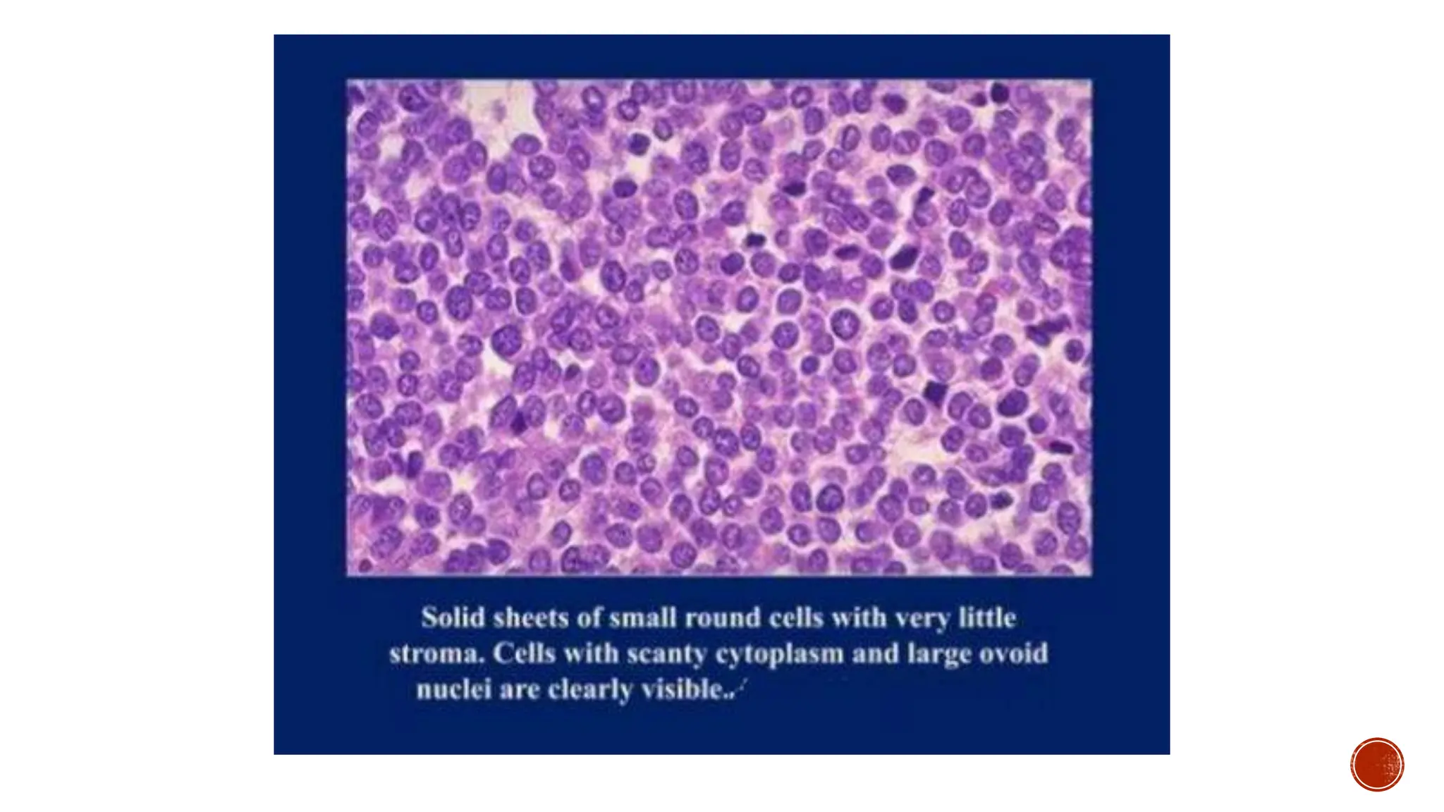 Non epithelial neoplasms.pptx oral pathology | PPTX