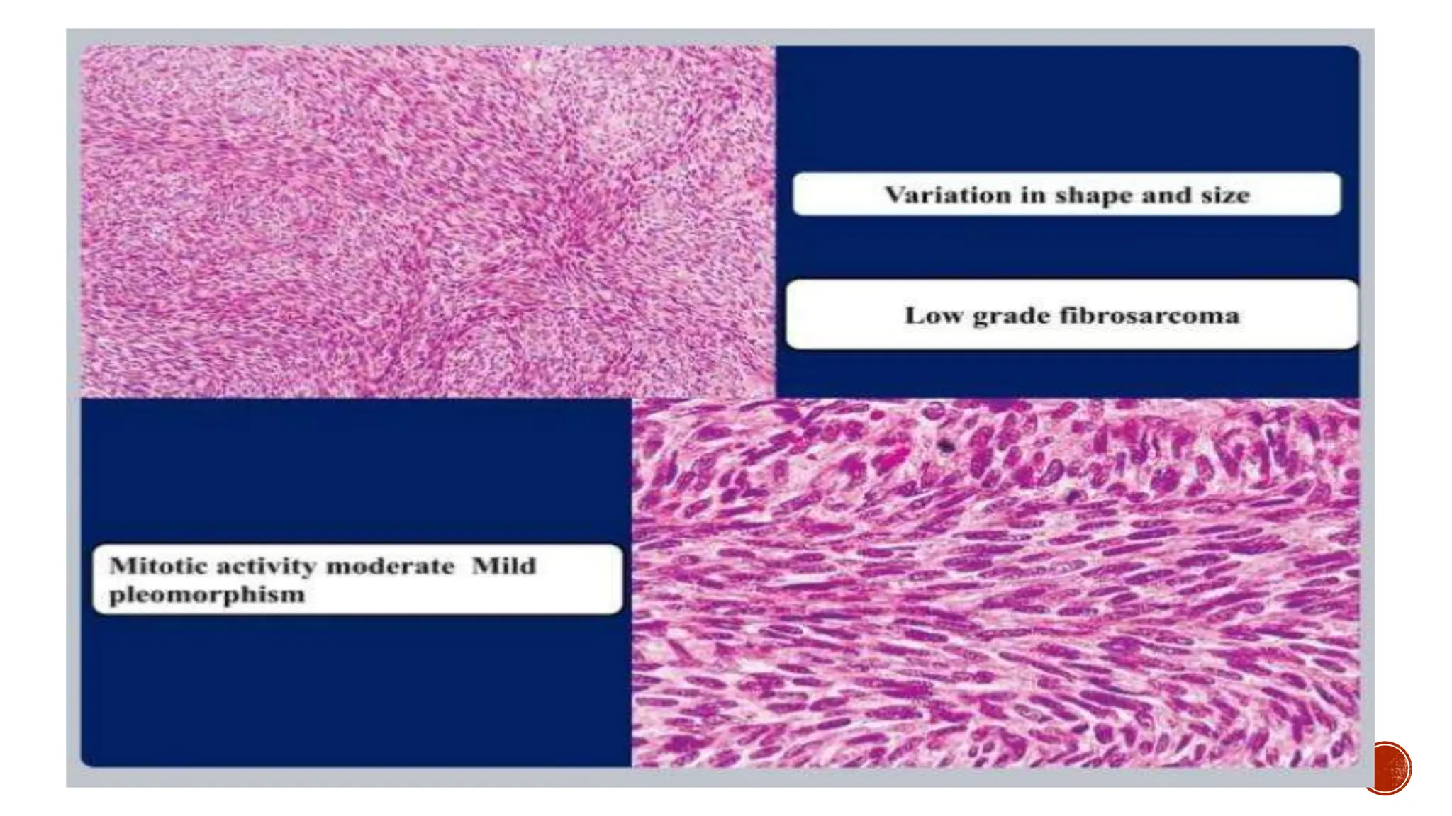 Non epithelial neoplasms.pptx oral pathology | PPTX