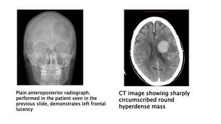 NON GLIAL TUMORS | PPT