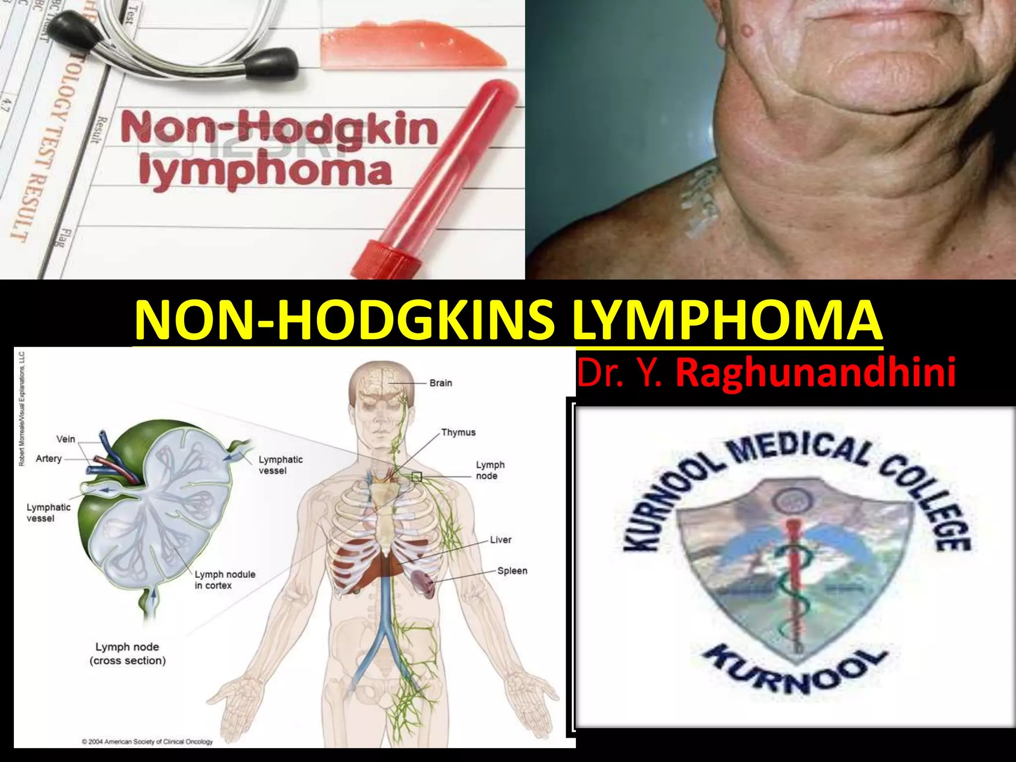 Non hodgkins lymphoma nandhu | PPTX