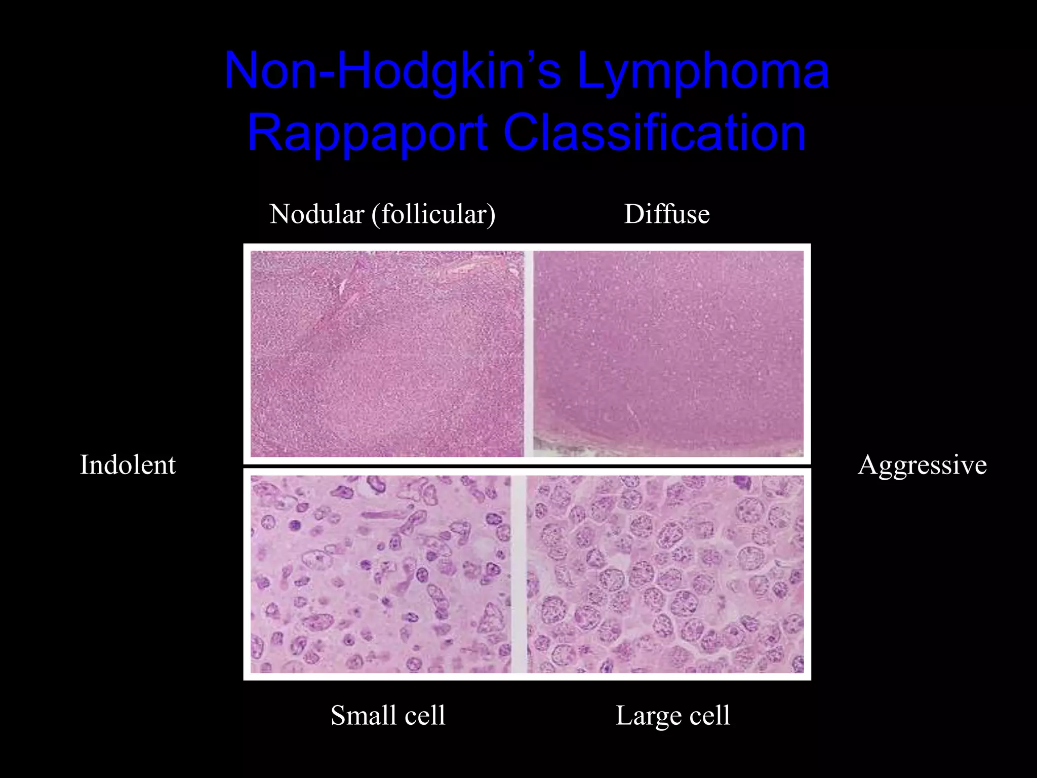 Non hodgkins lymphoma nandhu | PPTX | Blood Disorders | Diseases and Conditions